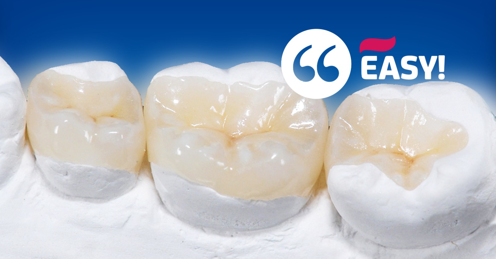 Intarsio dentale: che cosa è? | Centro Odontoiatrico Enrico Trova